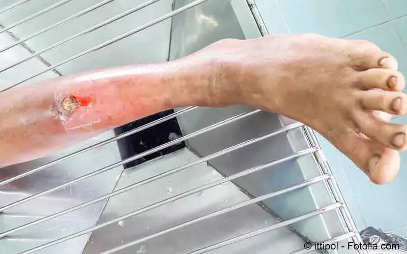 Offenes Bein Das Offene Bein • Naturheilpraxis