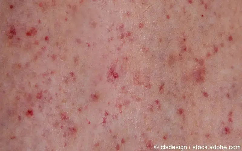 Leukämie Symptome Der Haut